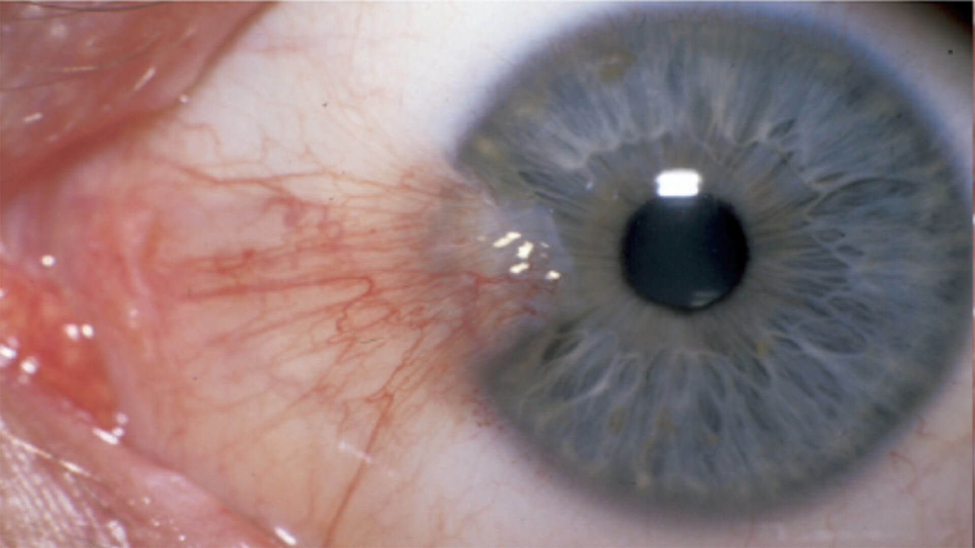 Dallas-Fort Worth Pterygium Treatment & Removal: Surfer's Eye Surgery